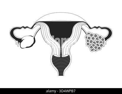 Late-stage ovarian cancer in female reproductive system 2D vector ...