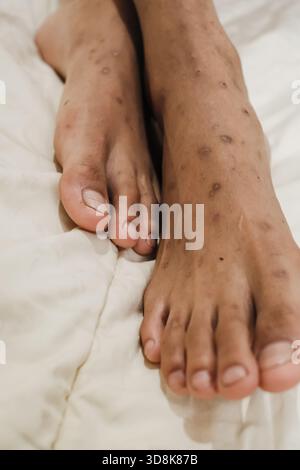 Close-up of psoriasis patches on the lower back of a person wearing ...