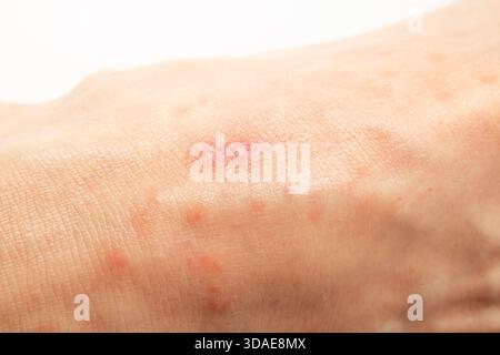 Close-up of a rash of blisters on the skin in a 58 year old female ...