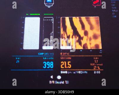 Cairo, Egypt, December 3 2025: Fibroscan examination study of the liver ...