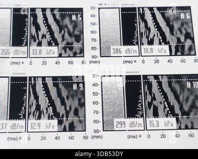 Cairo, Egypt, December 3 2025: Fibroscan examination study of the liver ...