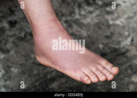 Swollen Foot After Cast Removal of Metatarsal Fracture Stock Photo - Alamy