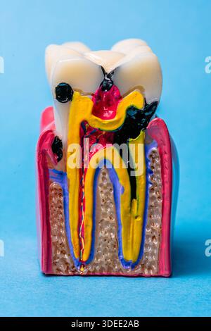 Dental molar cross section model showing enamel, dentin, pulp and an ...
