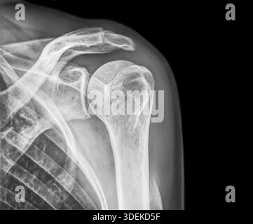 Patient who have shoulder pain. part of human female shoulder, high ...