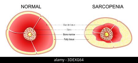 Sarcopenia. Age-related muscle atrophy. Comparison and Difference ...