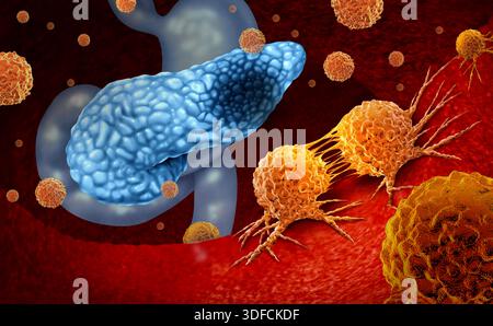 Pancreatic cancer concept and Pancreas malignant tumor symbol as a ...
