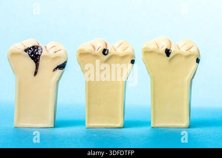 Tooth models showing caries progression and dental decay stages Stock ...