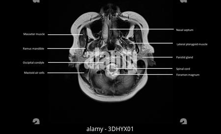 Labelled magnetic resonance imaging (MRI) scan of an axial section of a ...