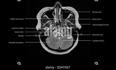 Labelled magnetic resonance imaging (MRI) scan of an axial section of a ...