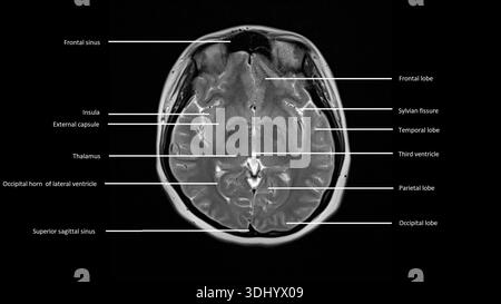 Labelled magnetic resonance imaging (MRI) scan of an axial section of a ...
