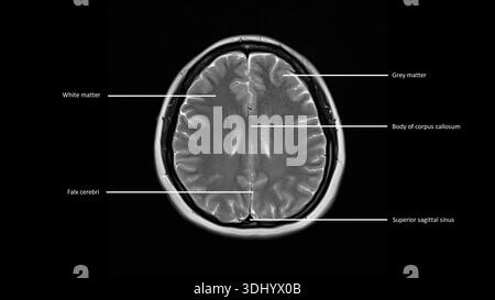 Labelled magnetic resonance imaging (MRI) scan of an axial section of a ...
