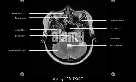 Labelled magnetic resonance imaging (MRI) scan of an axial section of a ...