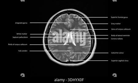 Labelled magnetic resonance imaging (MRI) scan of an axial section of a ...