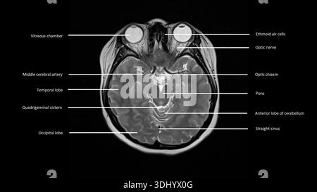 Labelled magnetic resonance imaging (MRI) scan of an axial section of a ...