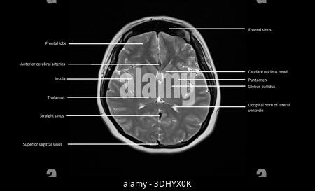 Labelled magnetic resonance imaging (MRI) scan of an axial section of a ...