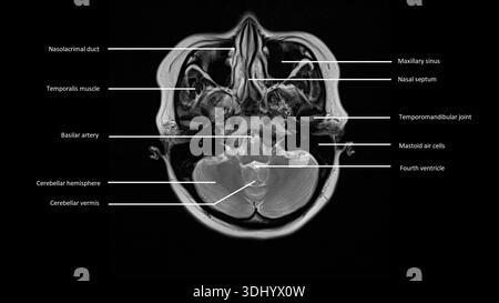 Labelled magnetic resonance imaging (MRI) scan of an axial section of a ...