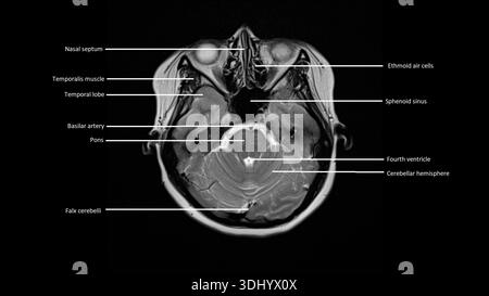Labelled magnetic resonance imaging (MRI) scan of an axial section of a ...