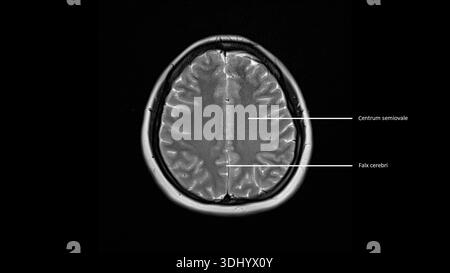 Labelled magnetic resonance imaging (MRI) scan of an axial section of a ...