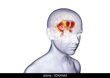 Illustration of a human brain with normal pressure hydrocephalus ...