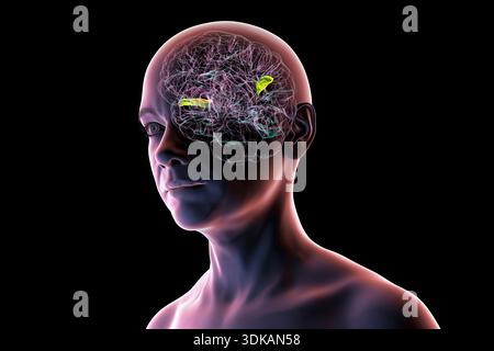 Illustration of the human brain with the transverse temporal gyri ...