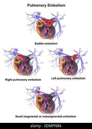 Illustration showing the three types of human louse. At top right is ...