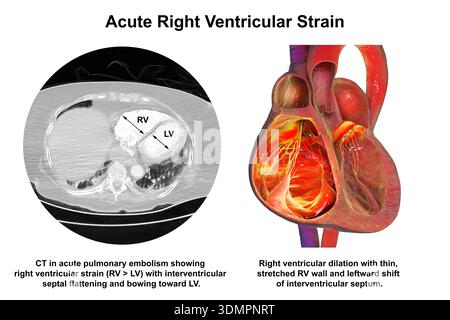 Illustration of right ventricular dilation showing a CT scan (left) and ...