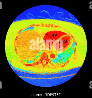 Colour-enhanced CT scan showing right ventricular strain in a patient ...