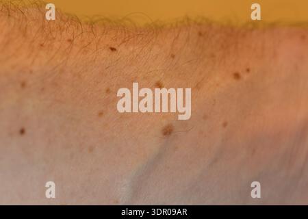 Human arm with multiple moles and freckles, skin cancer screening ...