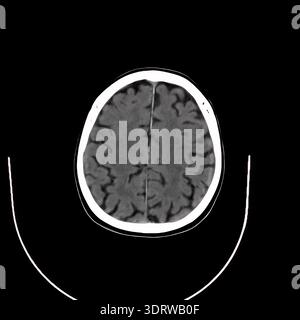 Human head CT scan presenting cranial anatomy including brain tissue ...