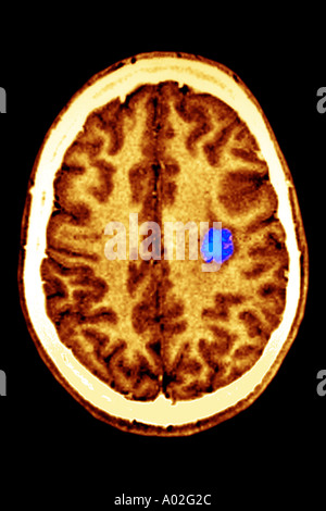 CAT scan showing glioma brain tumor Stock Photo - Alamy