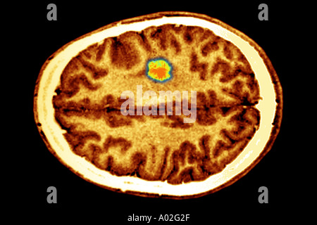 CAT scan showing glioma brain tumor Stock Photo - Alamy