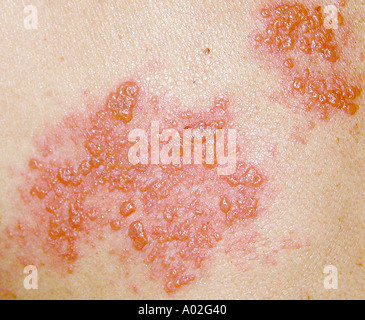 Herpes zoster rash Stock Photo - Alamy