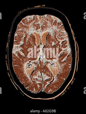 CT scan showing atrophy of both cerebral hemispheres Stock Photo - Alamy