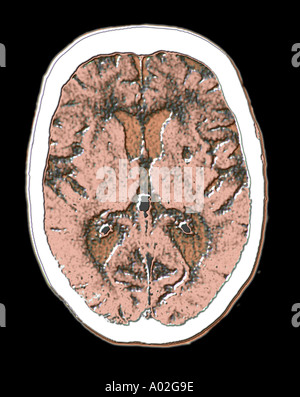 CT scan showing atrophy of both cerebral hemispheres Stock Photo - Alamy