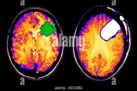 CT scan showing brain glioma in a 16 year old girl before surgery and post operative removal of ...