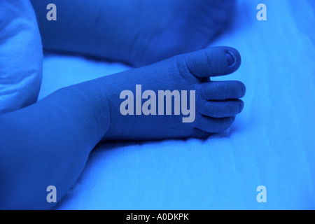 Premature baby with jaundice having phototherapy Stock Photo - Alamy