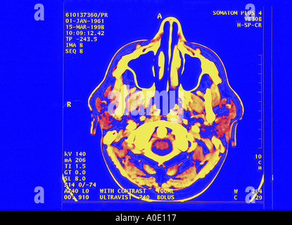 Coloured magnetic resonance imaging (MRI) scan of a sagittal section through a patient's head ...