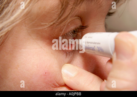 Zovirax gel in the eye to protect against shingles in the face Stock ...