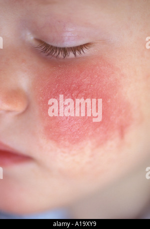 cheeks of child with eczema Stock Photo - Alamy