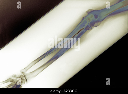 X-ray of left forearm. Medical imaging Stock Photo - Alamy
