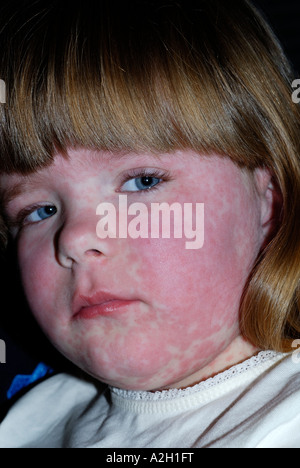 Amoxicillin drug rash on young girl Stock Photo - Alamy