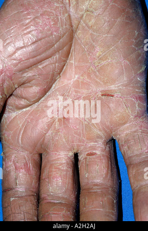 Skin rash of eczema on the palms of a 55 year old man showing severe ...