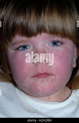Amoxicillin drug rash on young girl Stock Photo - Alamy