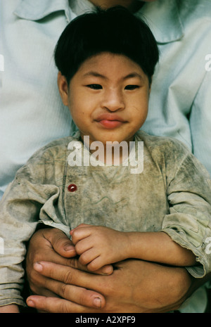 Quyen, 4, has microcephalia - tiny brain brain. Her father was sprayed ...