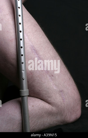 Scars resulting from broken femur numerous operations bone ...