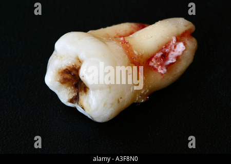 Decayed wisdom tooth Stock Photo - Alamy