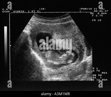 Foetal measurement, ultrasound scan Stock Photo - Alamy