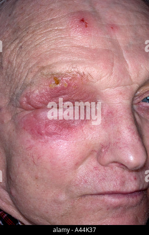 herpes zoster shingles rash on the face Stock Photo - Alamy