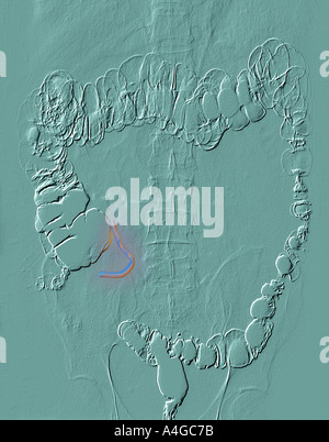 Barium enema xray showing appendix yellow and diverticula Stock Photo ...