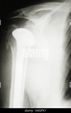 x-ray of shoulder replacement Stock Photo - Alamy